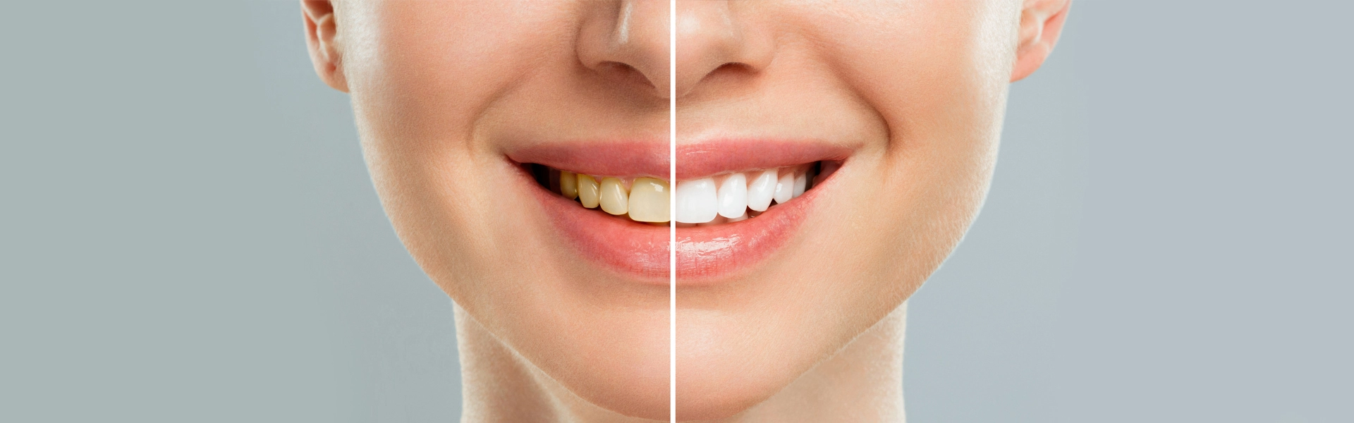Get a Camera-Ready Smile with Professional Whitening in Huntington Beach